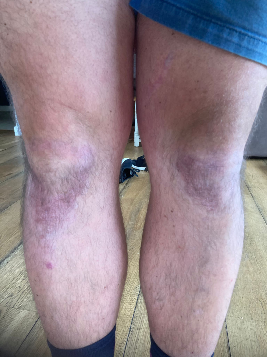 Healing of a Cement Burn | PhysioPod UK Ltd | Exclusive UK & Ireland ...