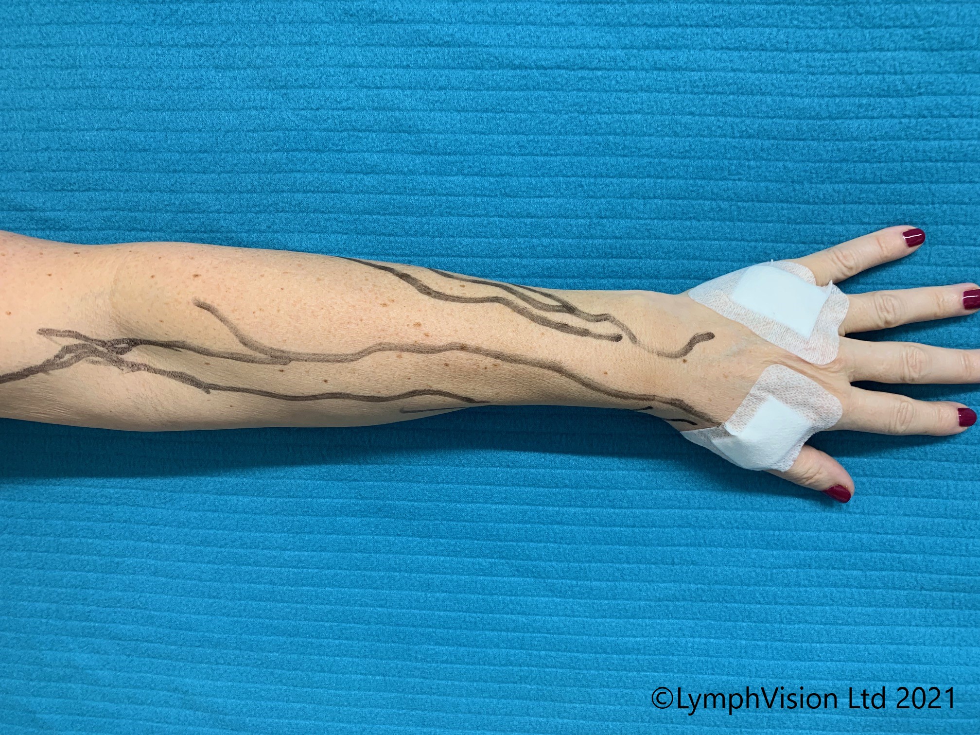 ICG Lymphographic Imaging - What Is It? How Does It Help Those Living ...