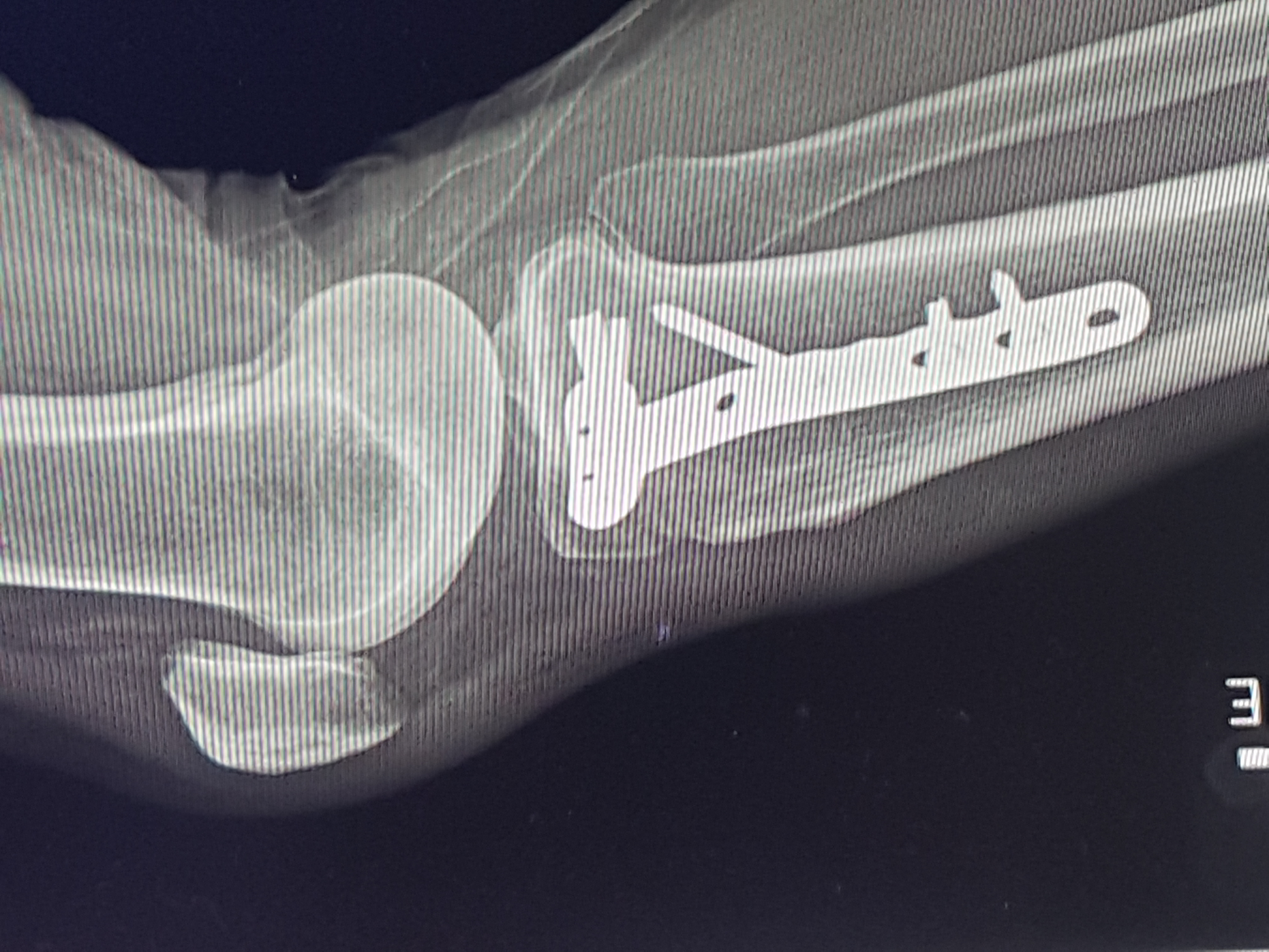 Medial Tibial Plateau Fracture: Rehabilitation with The Deep ...