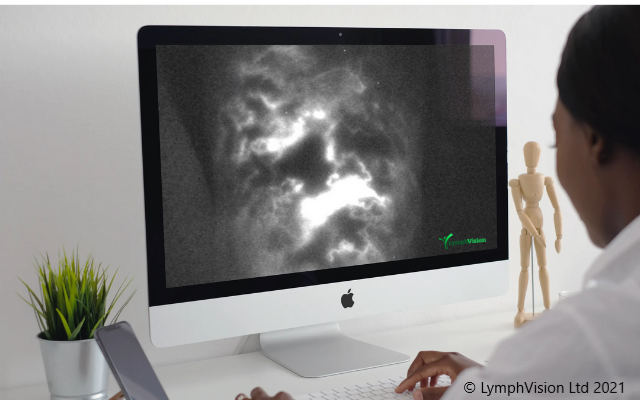 ICG Lymphographic Imaging - What Is It? How Does It Help Those Living ...