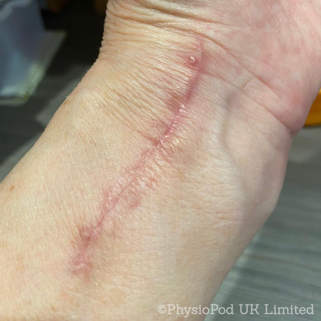 Scaphoid Fracture Surgery Scar