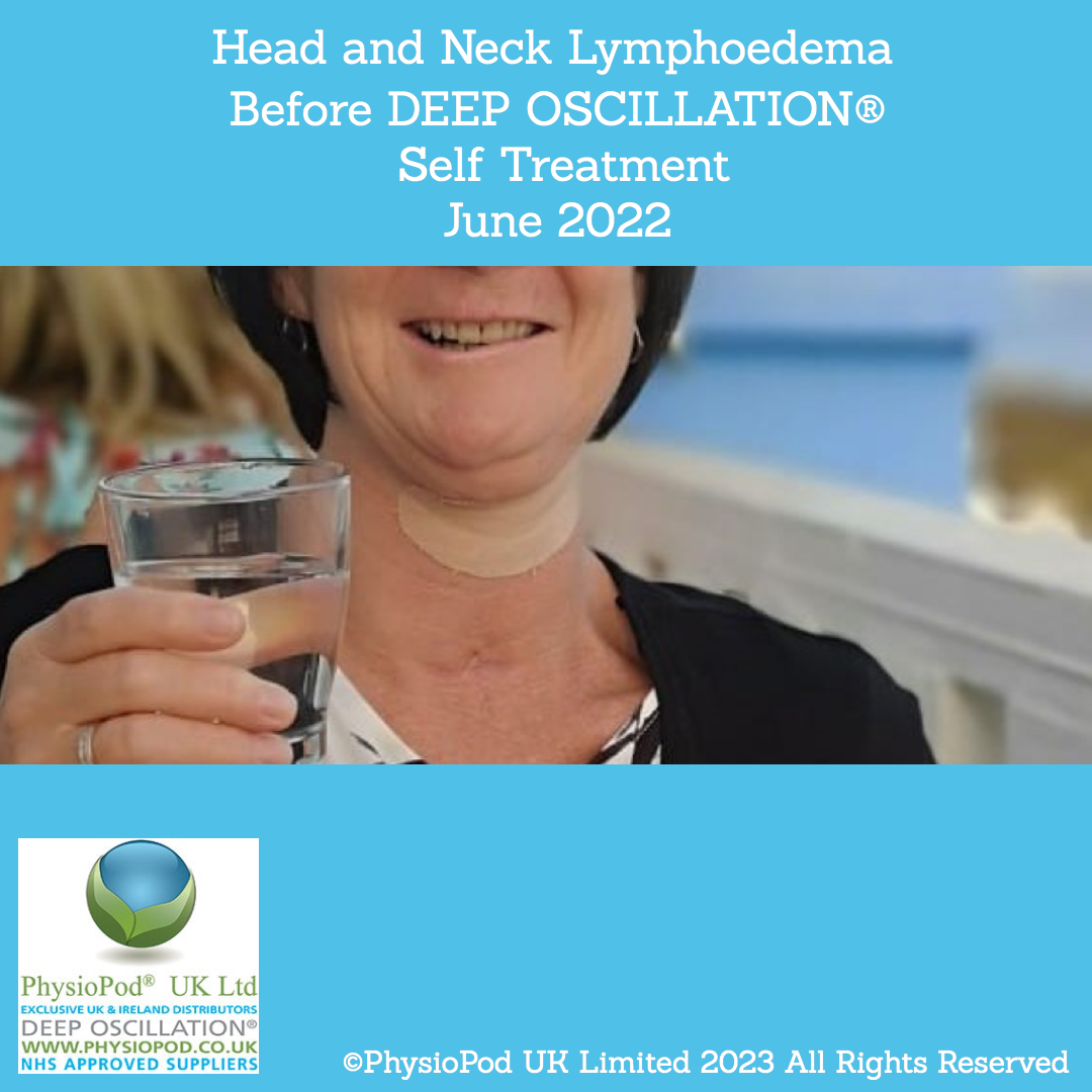 Head and Neck Lymphoedema - Deep Oscillation at Home | PhysioPod UK Ltd ...