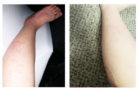 Patient Describes Heat Rash Treatment with Deep Oscillation | PhysioPod ...