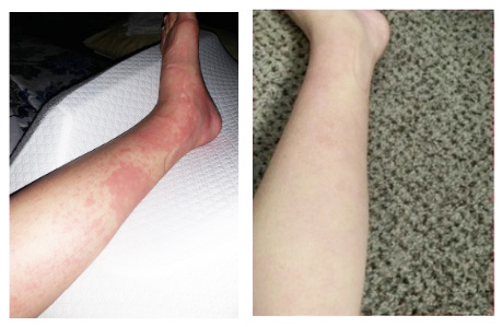 Patient Describes Heat Rash Treatment with Deep Oscillation | PhysioPod ...