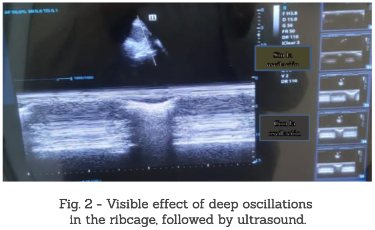 Visible Effect of Deep Oscillations in the Lung Field Followed by ...