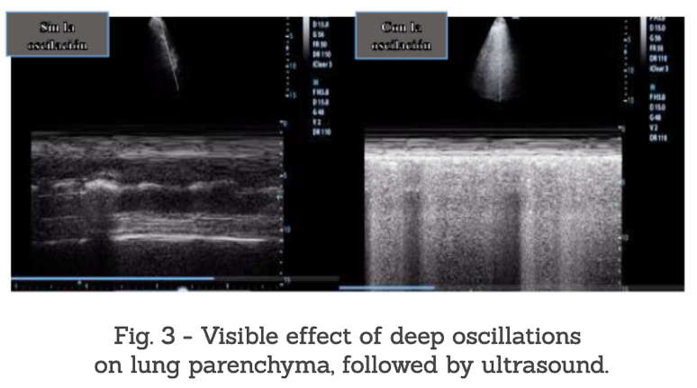 Visible Effect of Deep Oscillations in the Lung Field Followed by ...