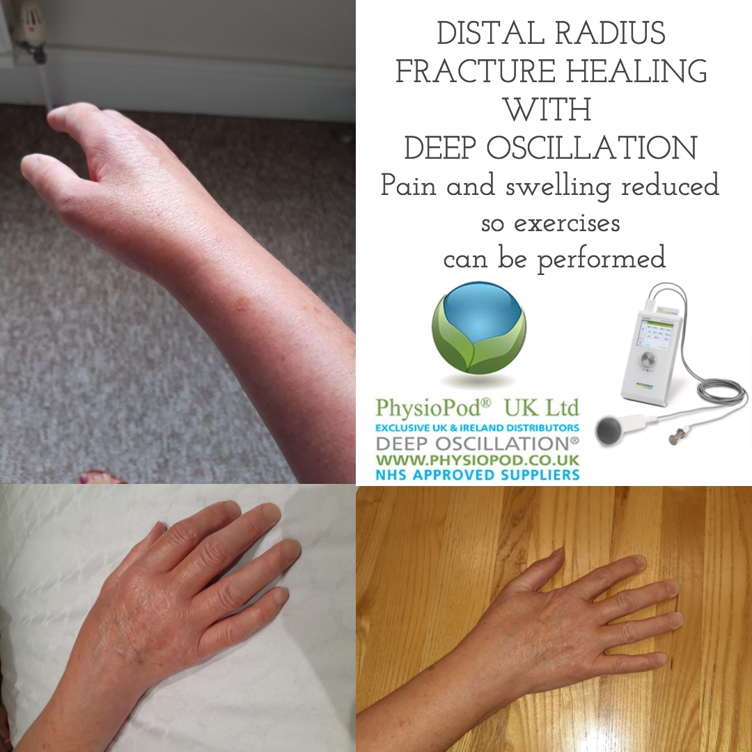 Distal Radius Fracture Healing Enhanced with Deep Oscillation ...